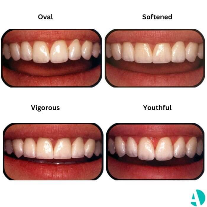 Types Of Dental Veneers Shapes And Colors Antlara Dental Clinic